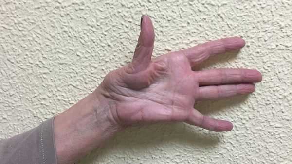 Rizartrosis Qué es, Síntomas y Tratamiento - Dra Levy & Equipo